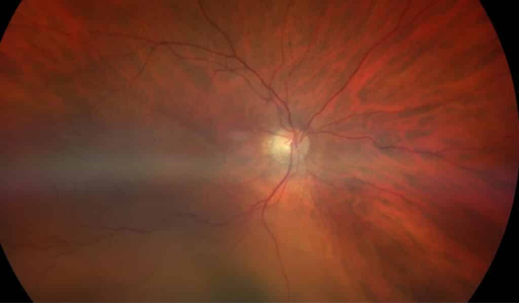 Desprendimiento de Retina Bilbao · Vizcaya | Instituto Oftalmológico ...