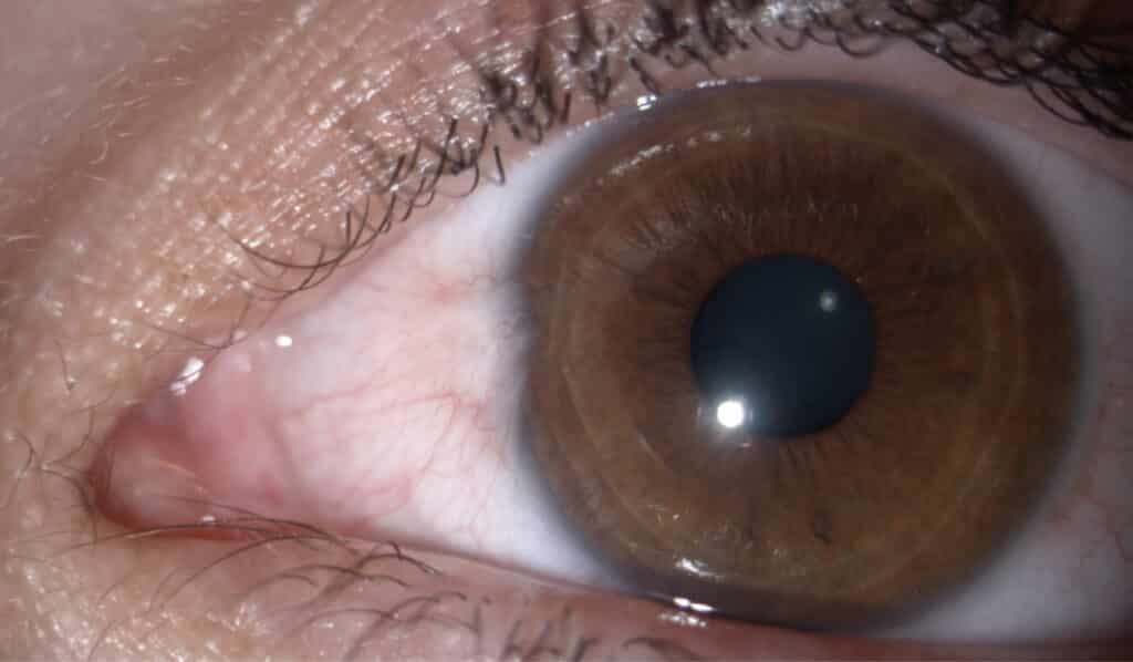 Pterigion y pinguécula, qué es, causas y tratamiento - IORR Oftalmología